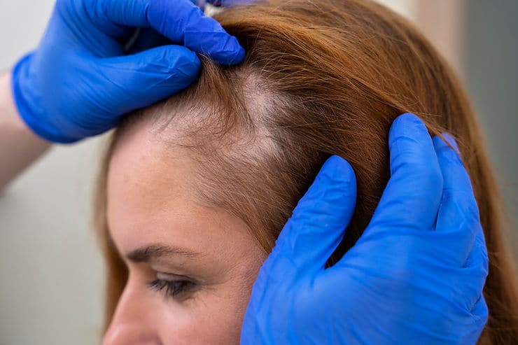 Female Hair Thinning 2026: 7 Causes + Free Ludwig Stage Test