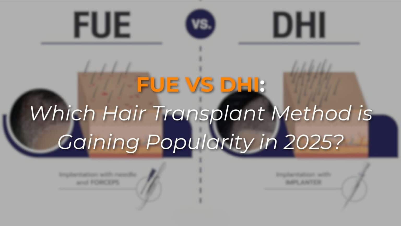 FUE vs. DHI: The Most Popular Hair Transplant Method in 2025